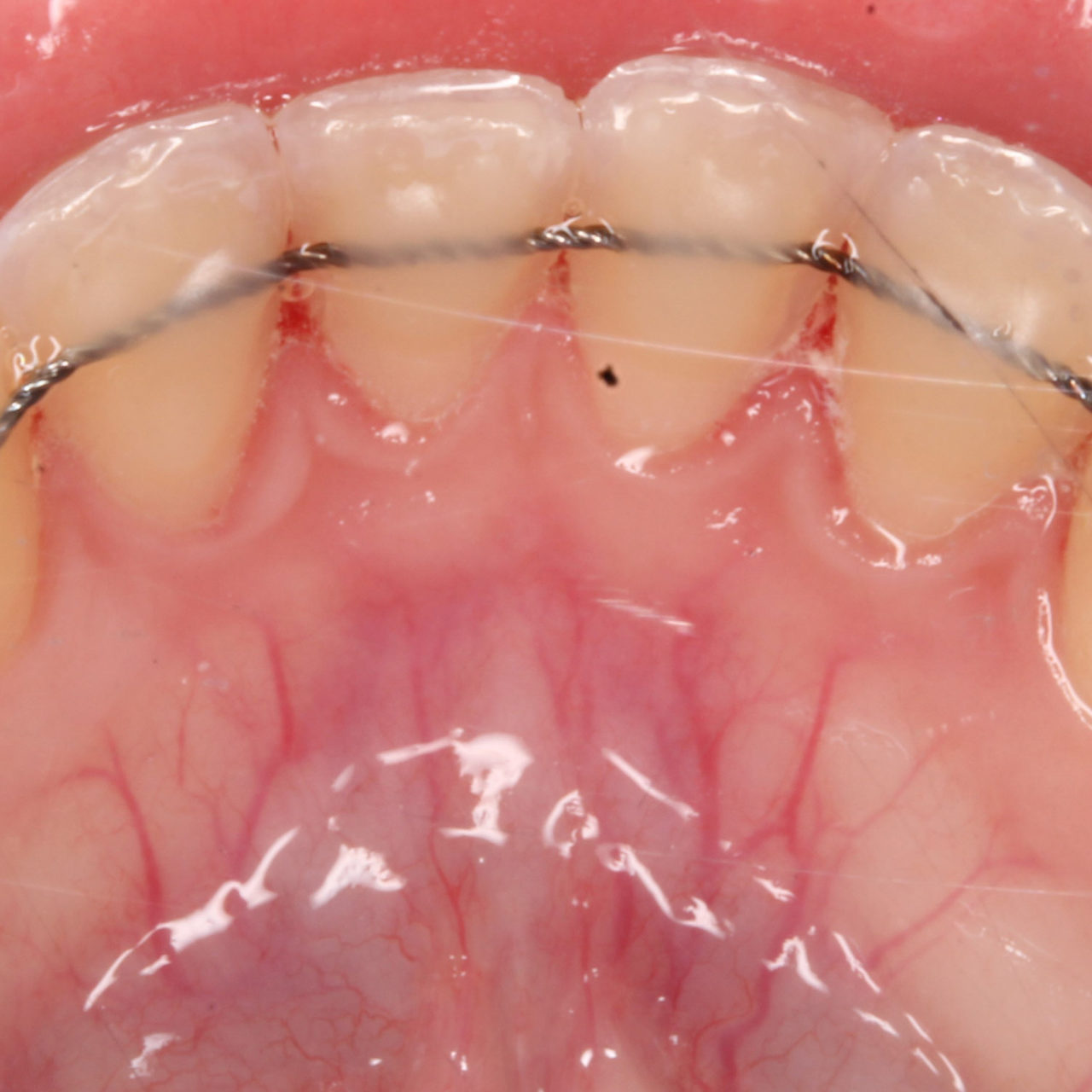 Eingliederung eines festsitzenden retainers gesondert berechenbar